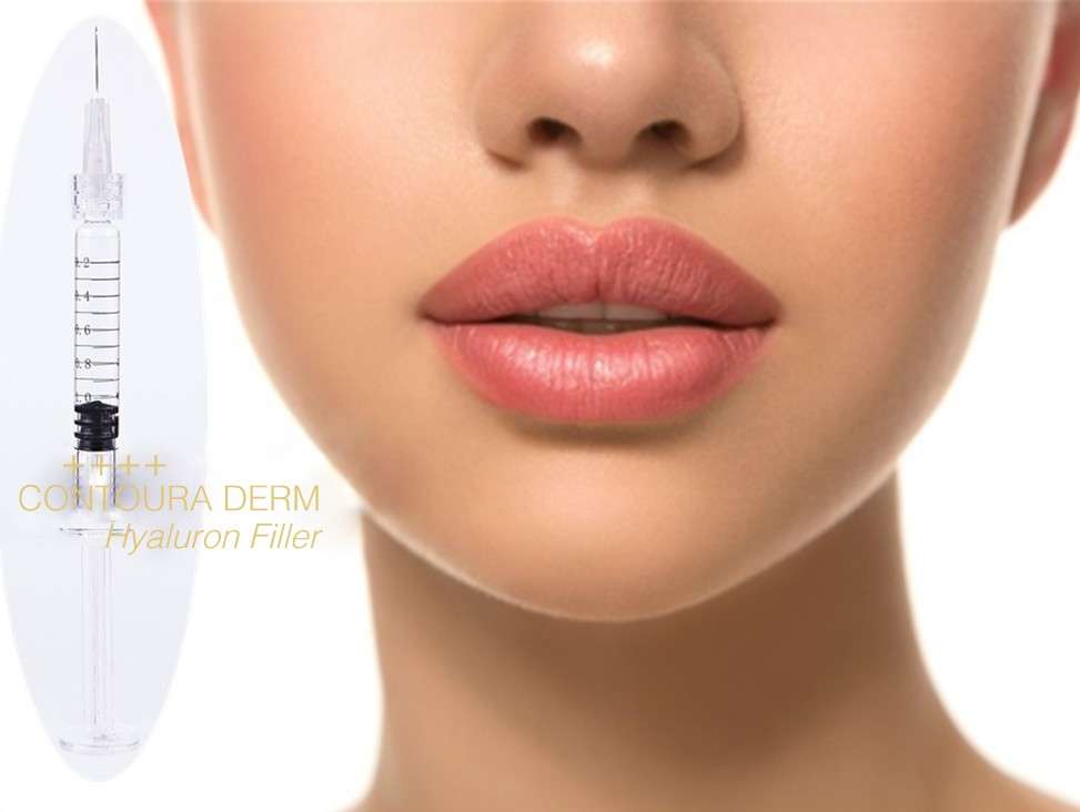 Hyaluron für Lippen kaufen ohne Rezept, Filler Lippenunterspritzung ...
